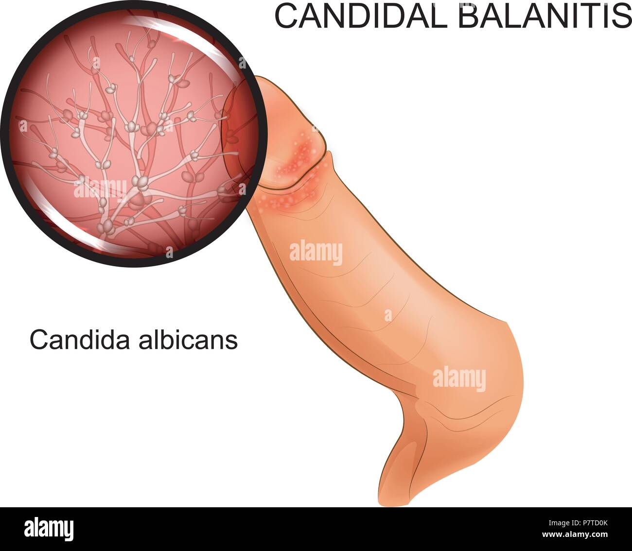 vector illustration of a candidiasis of the penis Stock Vector Image Art Alamy
