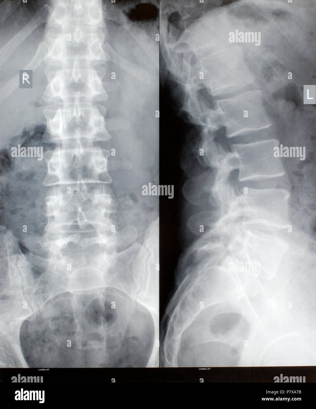 Slipped disc x ray hi-res stock photography and images - Alamy