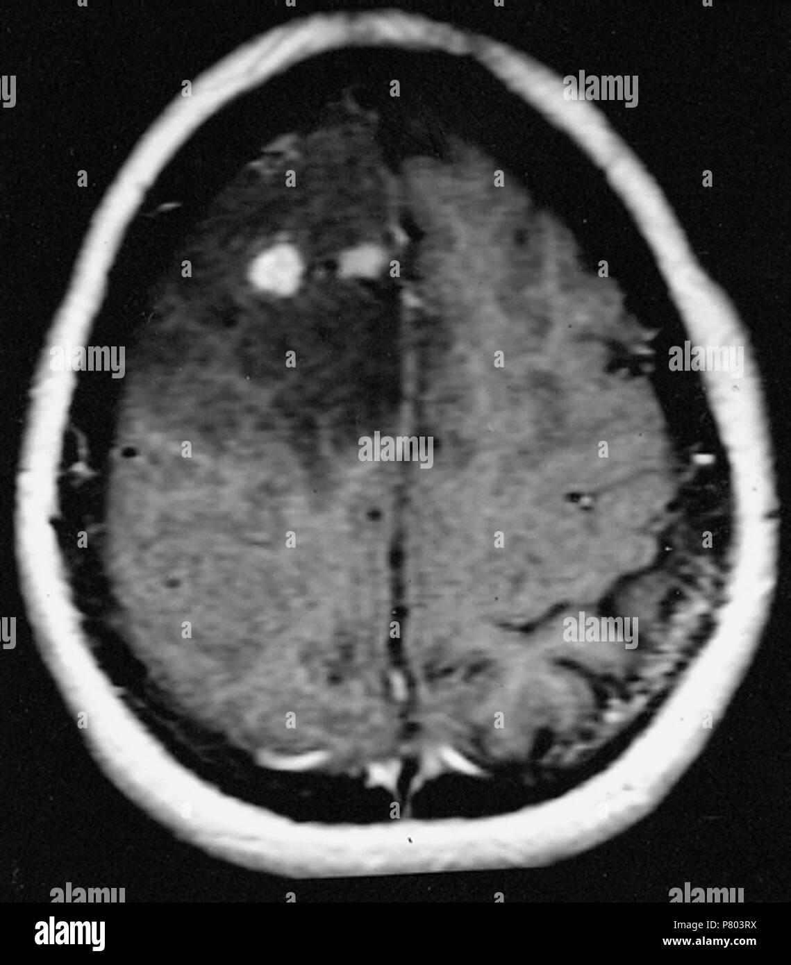 Astrocytic hi-res stock photography and images - Alamy