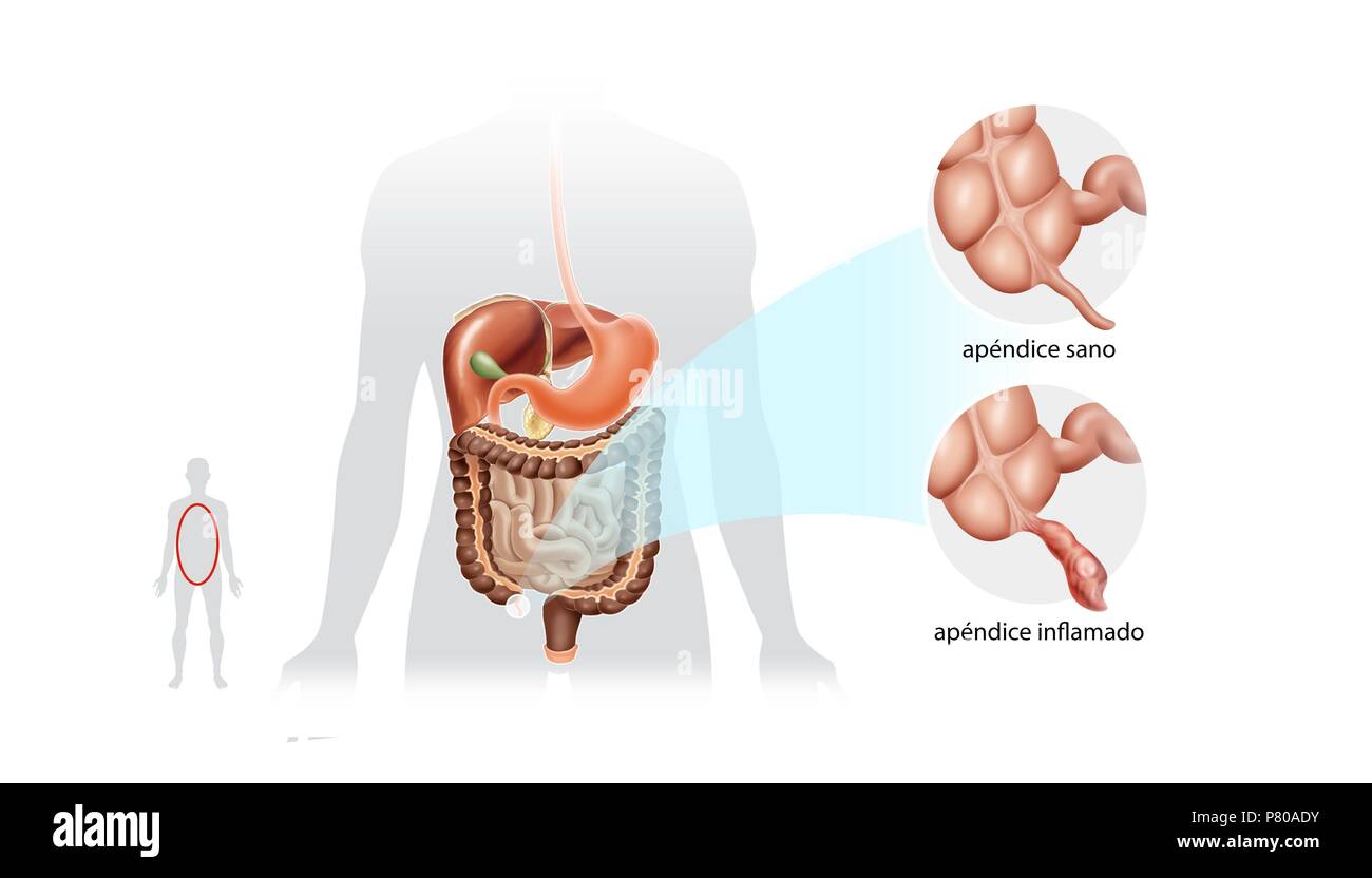 Illustration appendix appendicitis Cut Out Stock Images & Pictures - Alamy