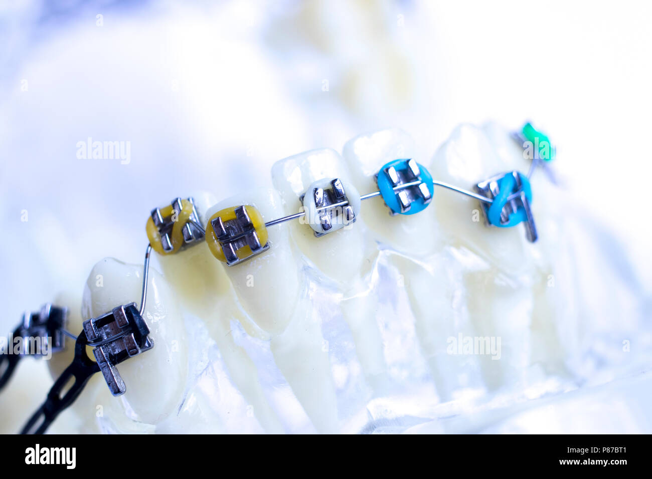 Dental metal braces teeth retainer aligners teaching orthodontics model ...