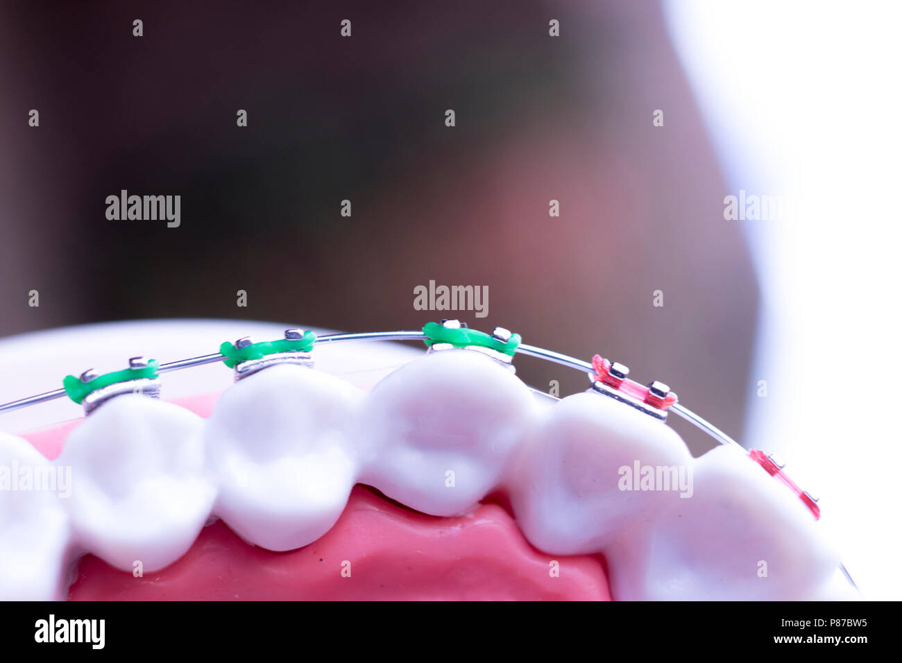 Dental metal braces teeth retainer aligners teaching orthodontics model ...