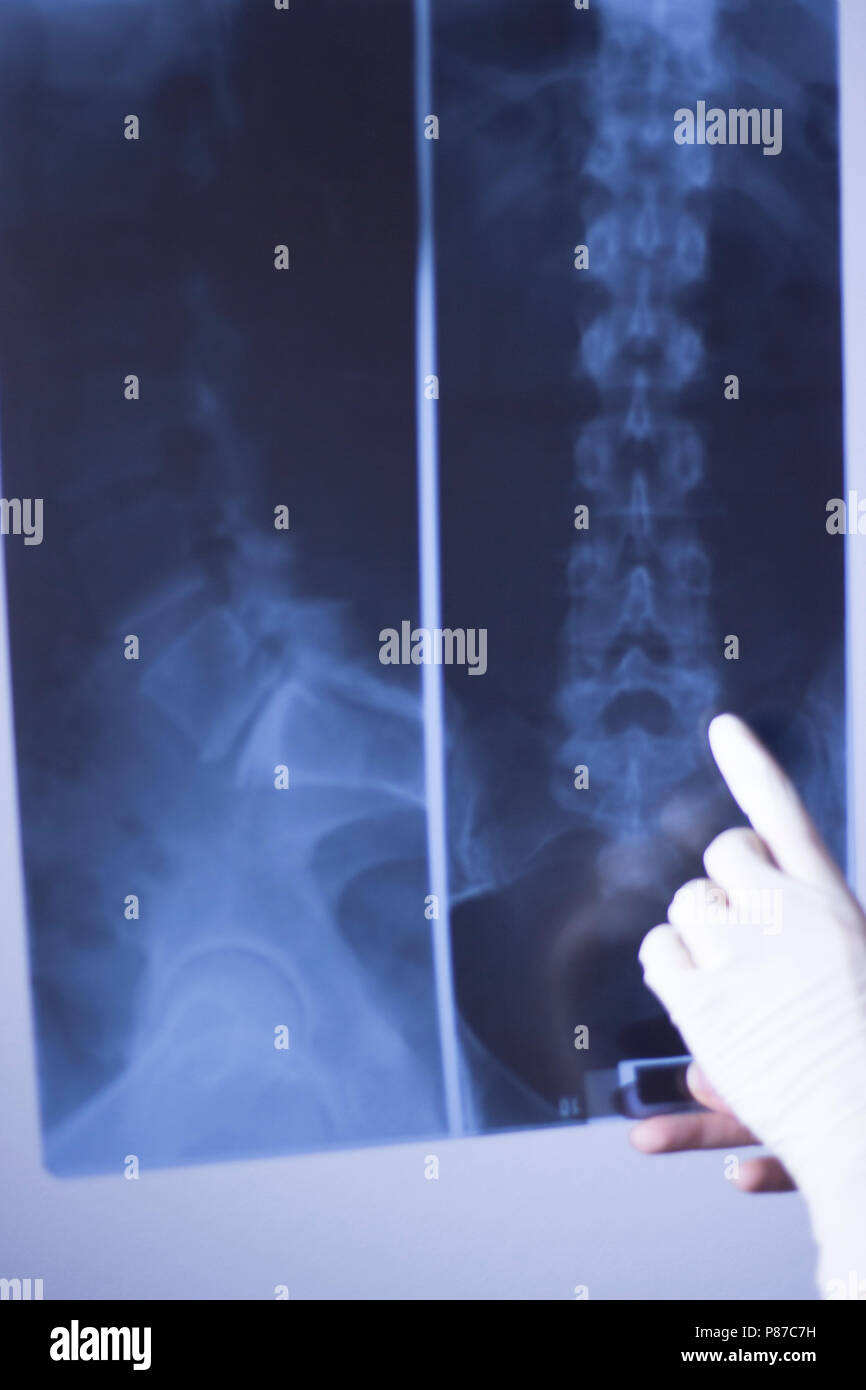 Medical hospital x-ray lowe back pain spine and hips traumatology scan ...