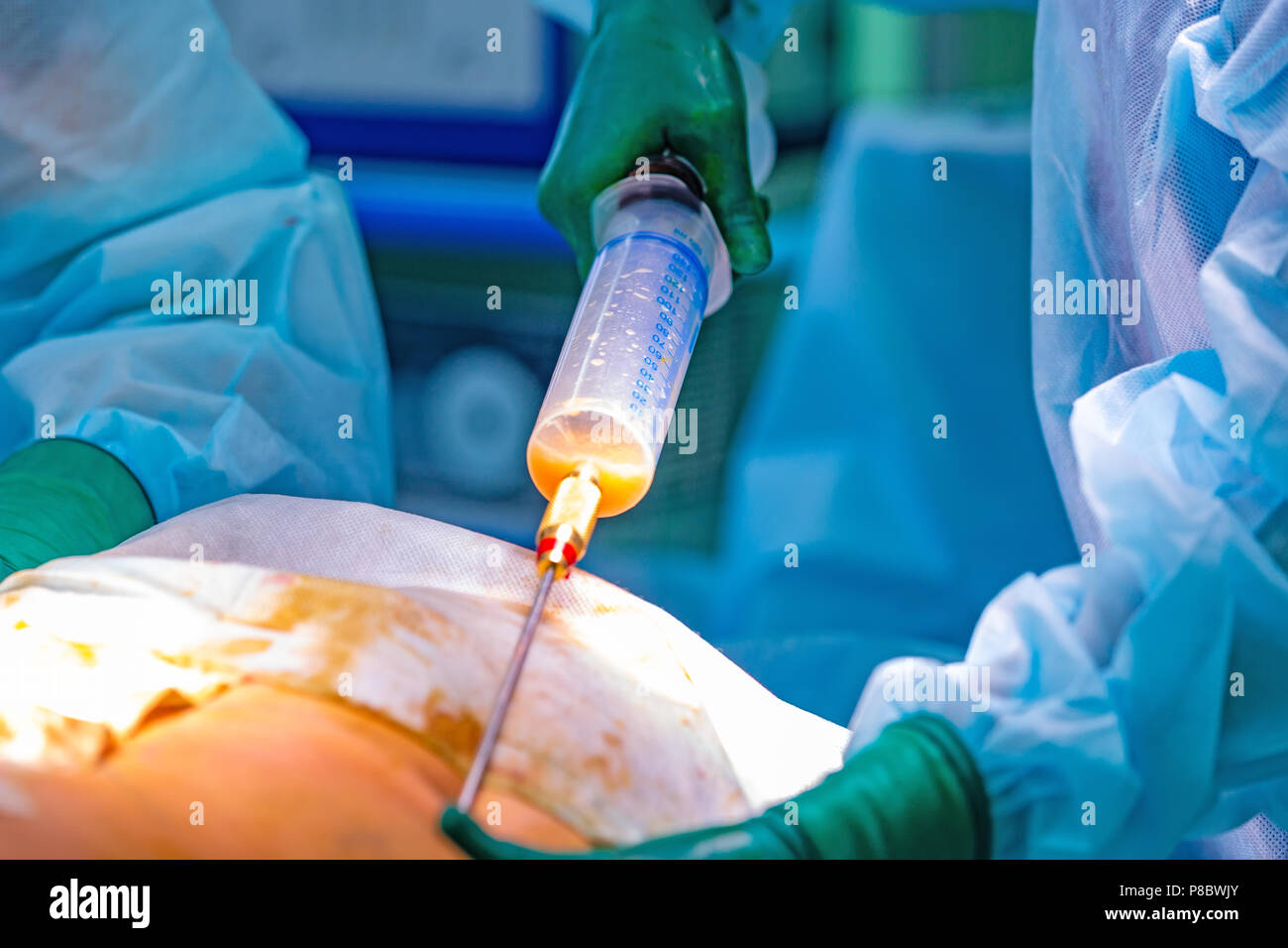 cosmetic liposuction surgery in actual operating room setting showing ...