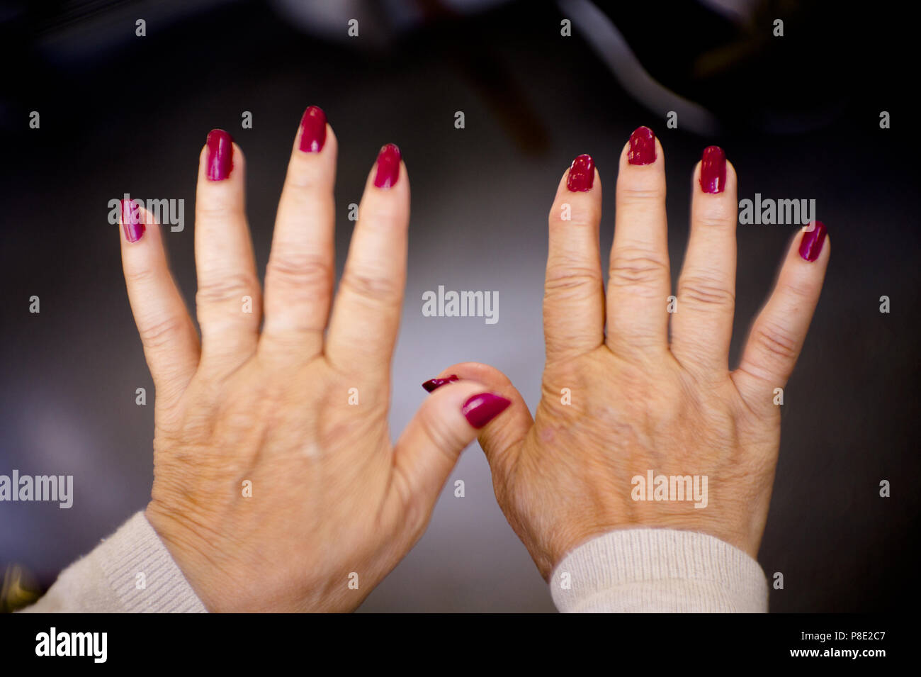 Hands of a middle aged woman with problems of rheumatism ...