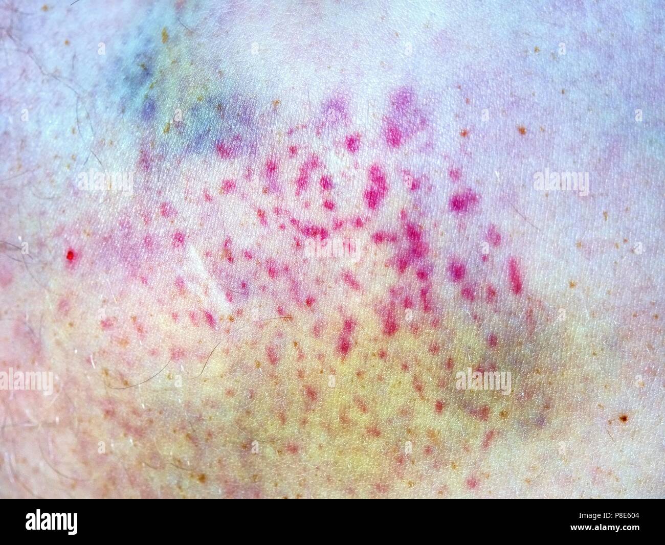 Bruised wound injury on human body. Patient show injured body with ...