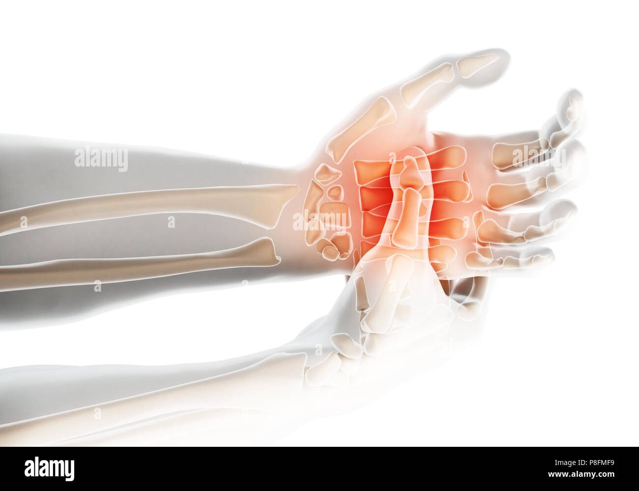 3D illustration of Palm painful - skeleton x-ray, medical concept Stock ...