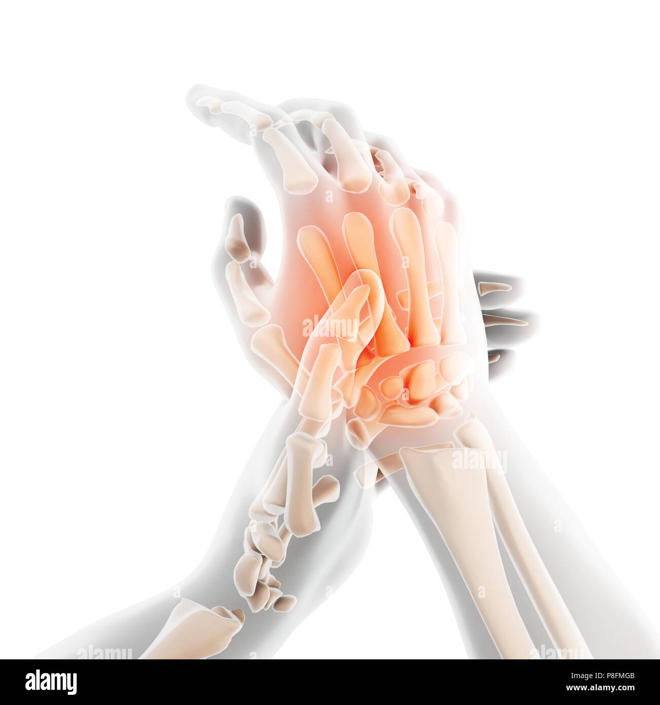 3D illustration of Palm painful - skeleton x-ray, medical concept Stock ...
