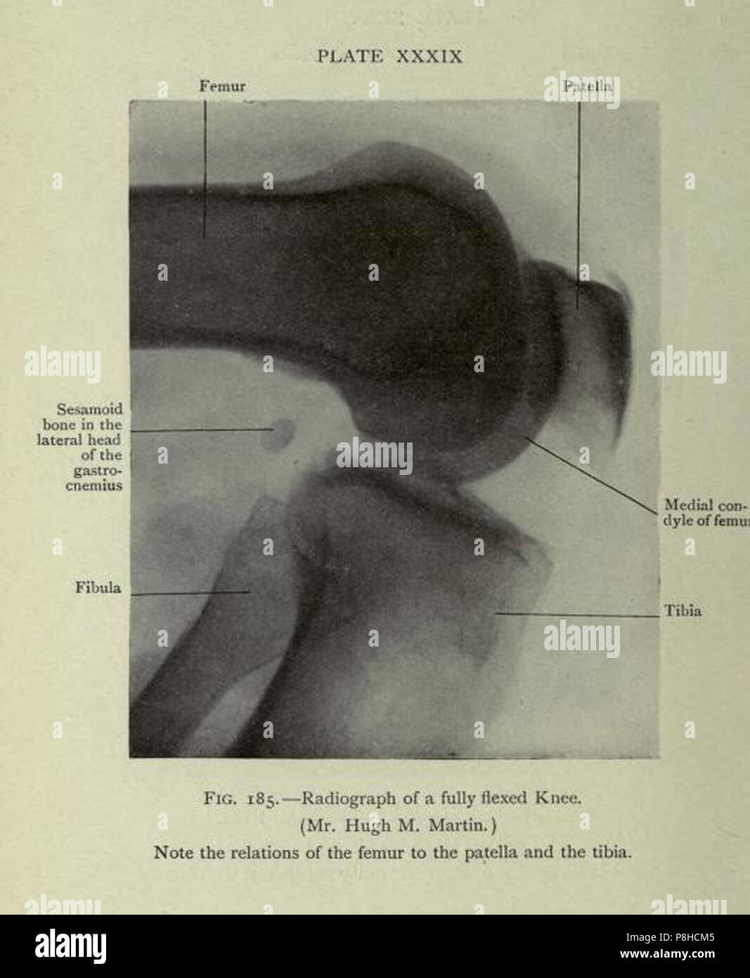 vintage radio graphic x-ray plate annotated Stock Photo - Alamy