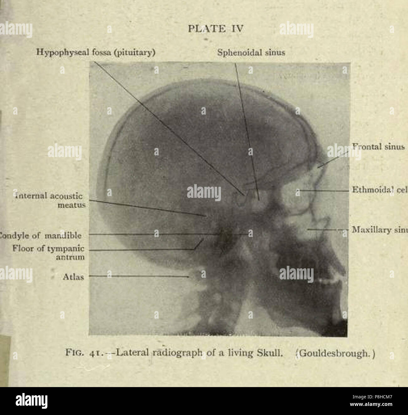 vintage radio graphic x-ray plate annotated Stock Photo - Alamy