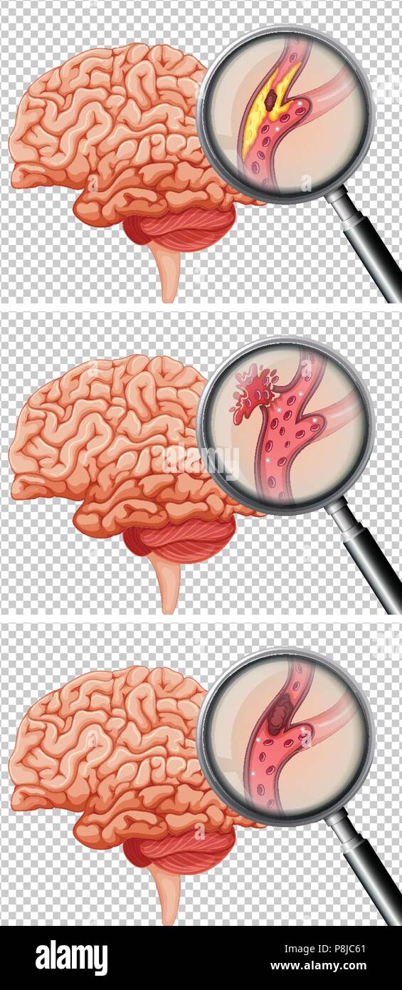 A Set of Human Brain With Stroke illustration Stock Vector Image & Art ...
