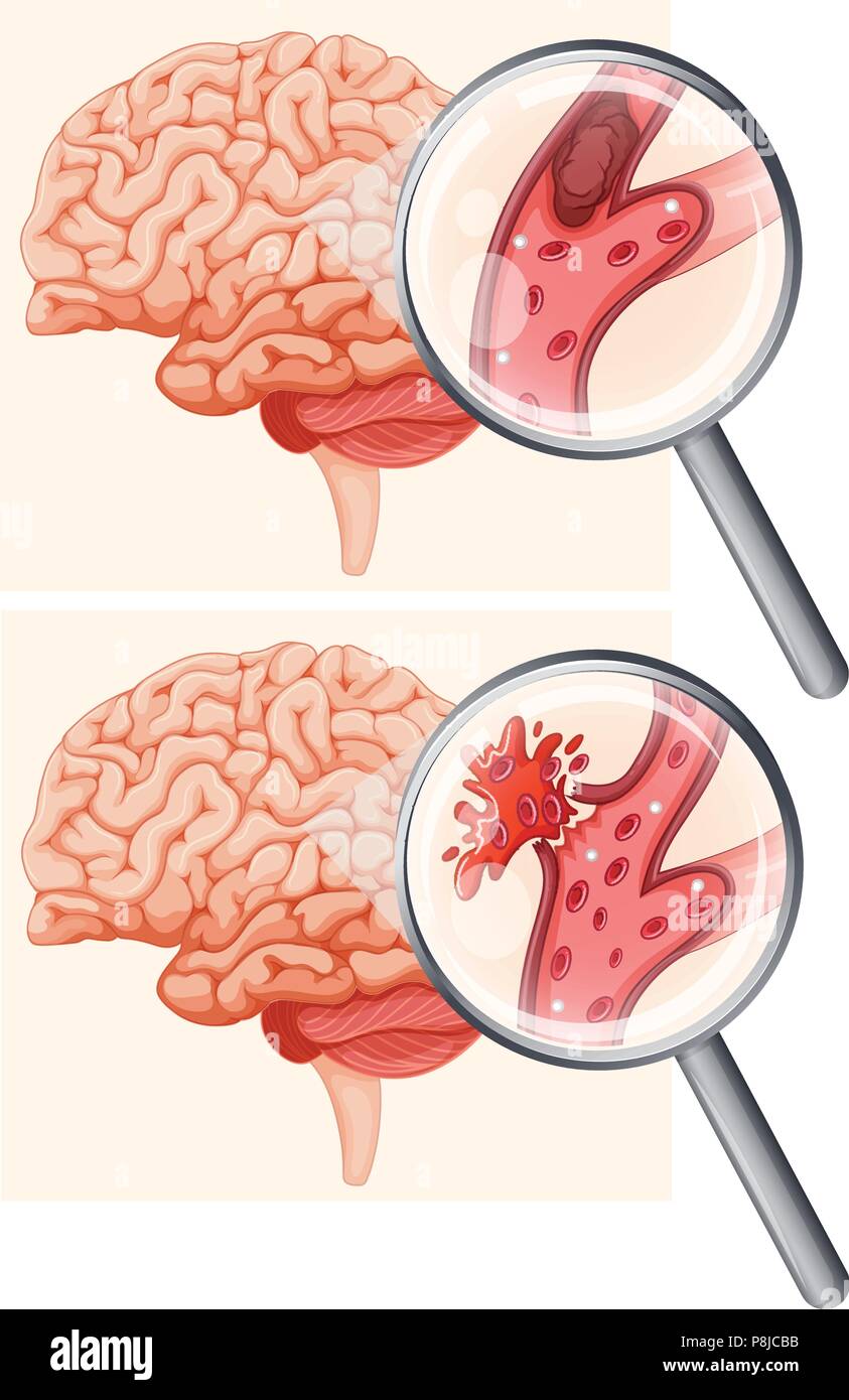 Hemorrhagic Stroke High Resolution Stock Photography and Images - Alamy