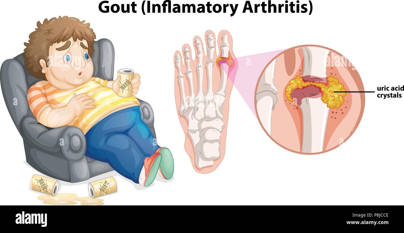 Uric Acid Crystals In Urine Infant