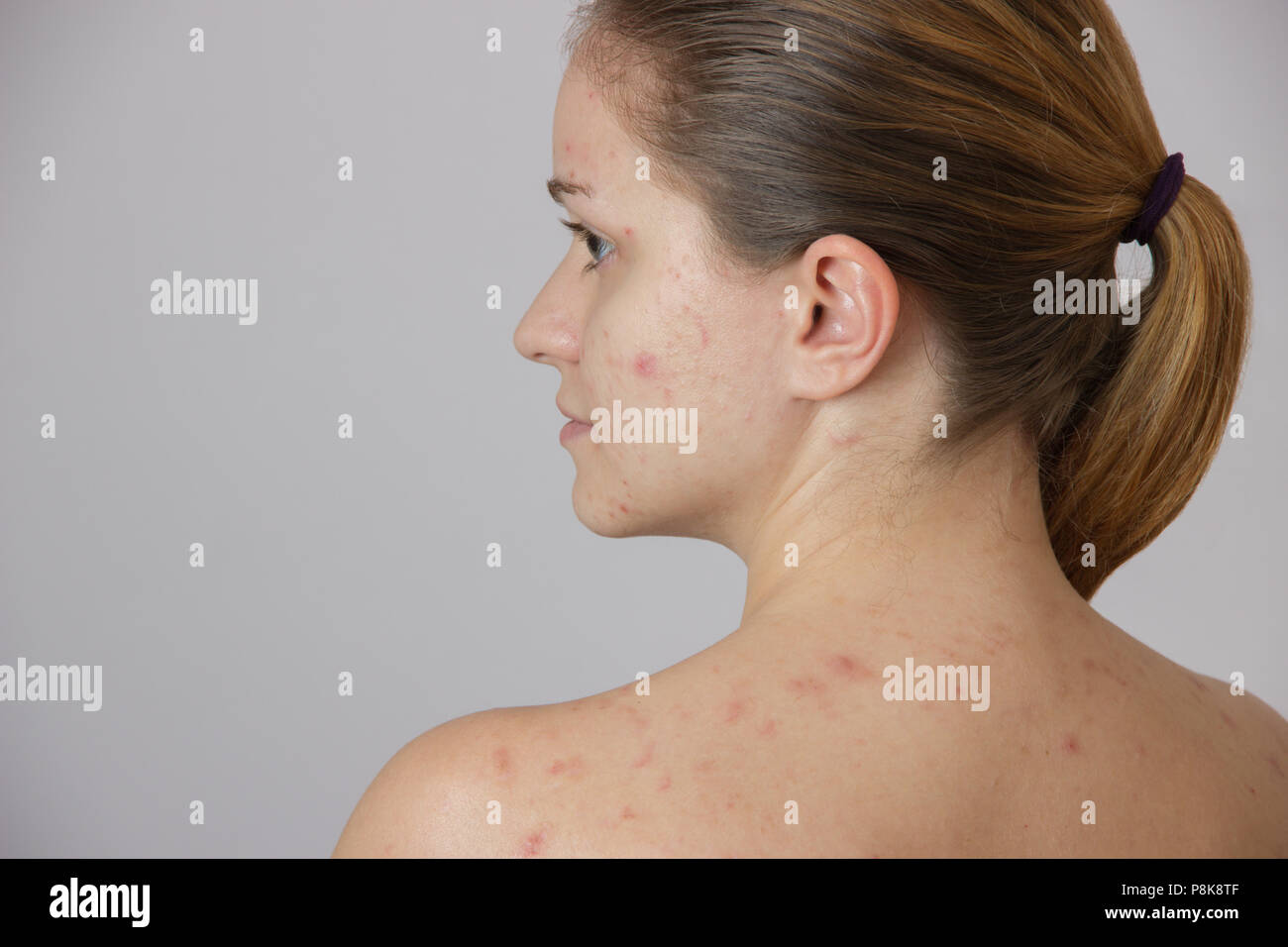 Face Blemish Stock Photos & Face Blemish Stock Images - Alamy