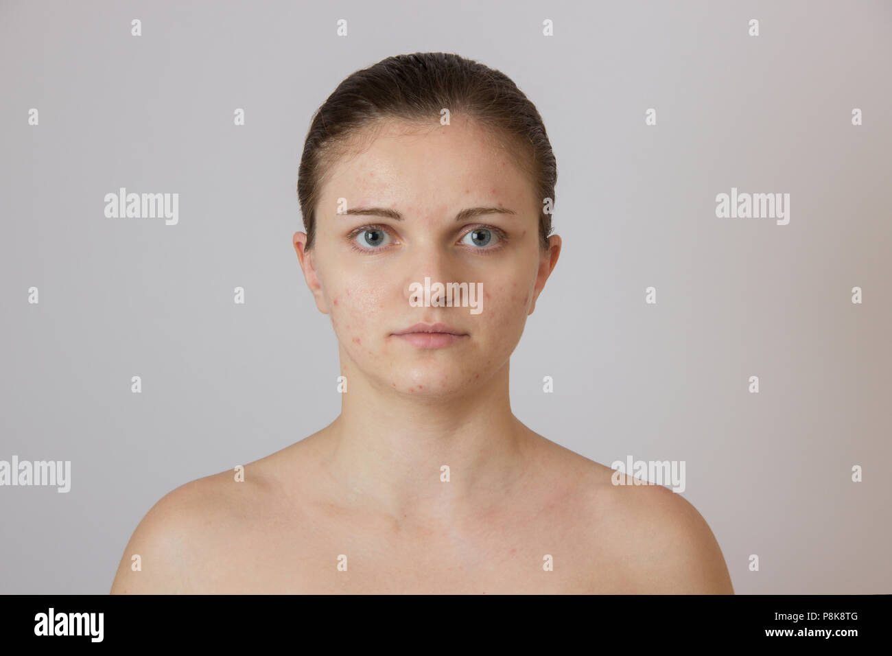 Beautiful young girl with acne on his face on a white background Stock ...