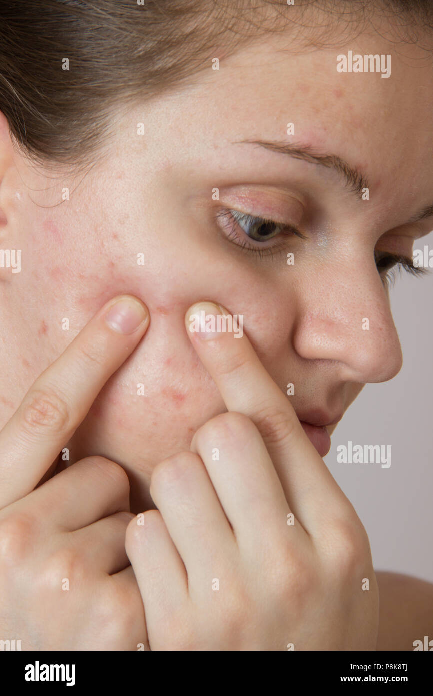 Face Blemish Stock Photos & Face Blemish Stock Images - Alamy