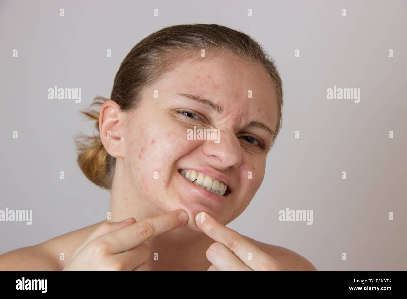 Beautiful young girl with acne on his face on a white background Stock ...