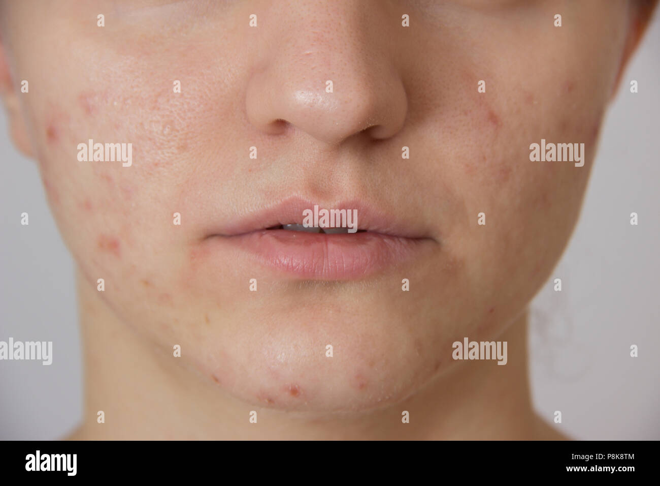 White Acne Scars On Face