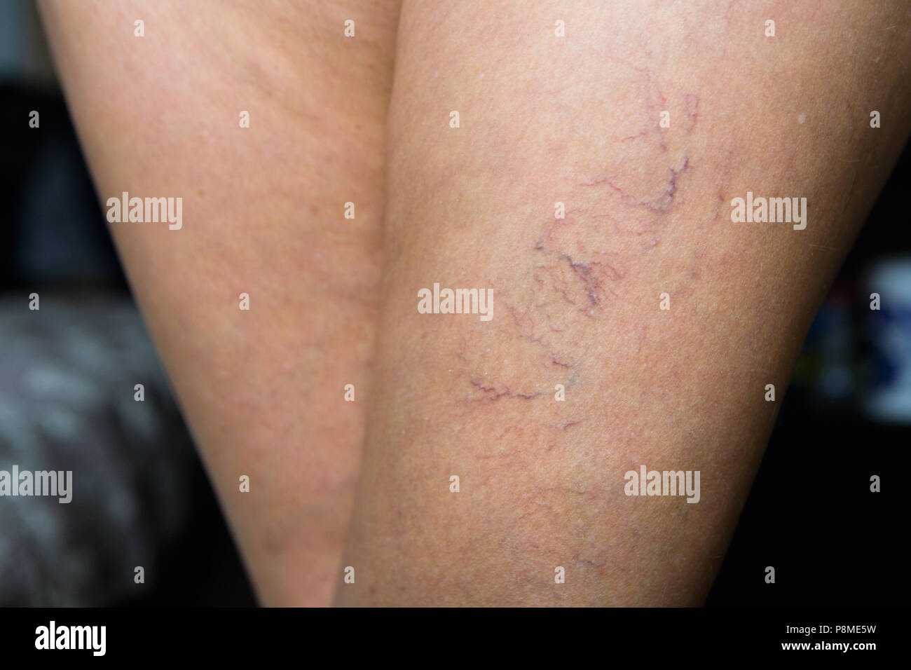 Ugly small veins are visible on the female leg. Health Stock Photo - Alamy