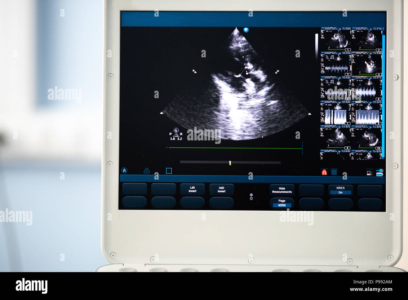 Left atrium echocardiogram hi-res stock photography and images - Alamy