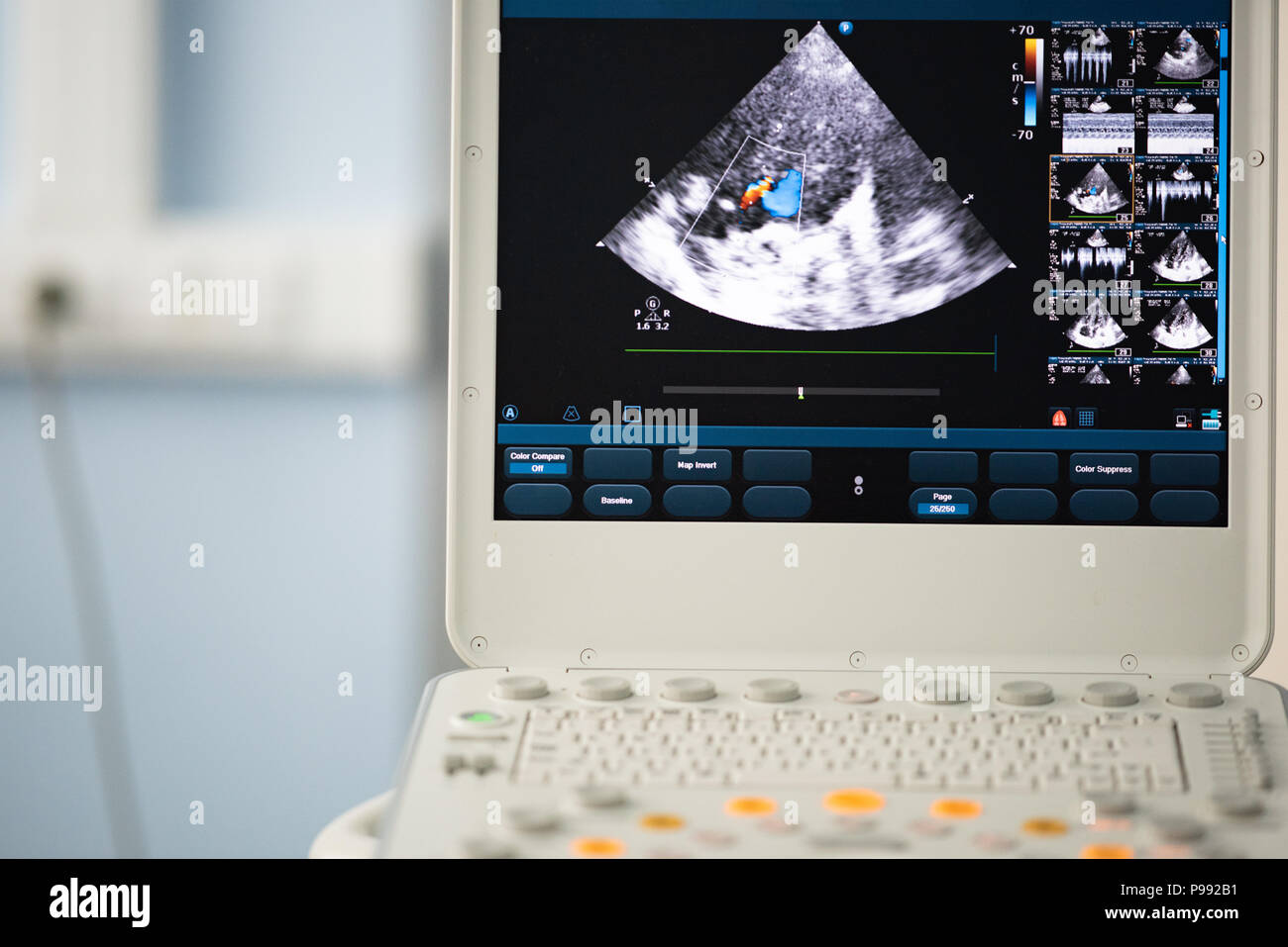 On the ultrasound screen, the Doppler method depicts regurgitation on ...