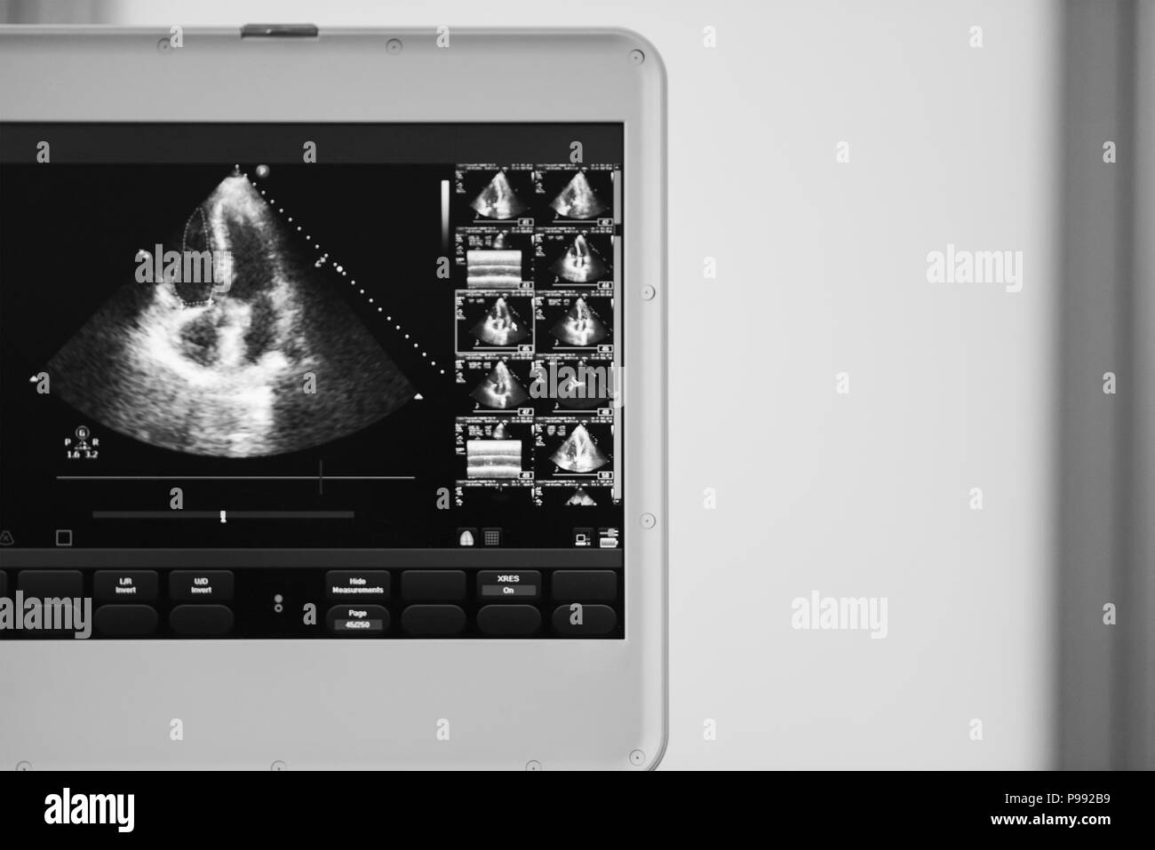 The screen of the ultrasound device shows a scan of the heart in a four ...