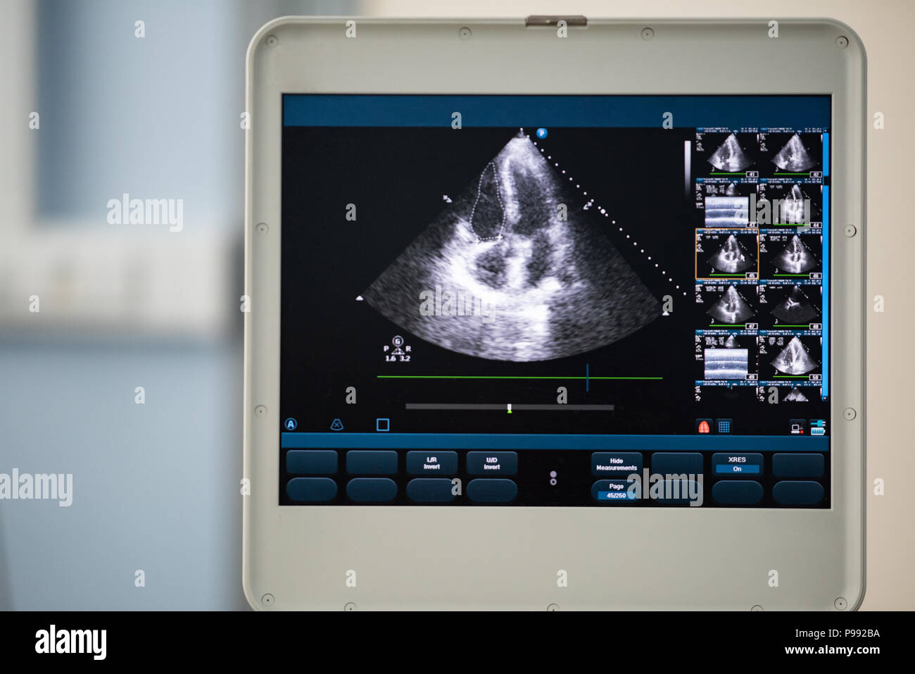 The screen of the ultrasound device shows a scan of the heart in a four ...