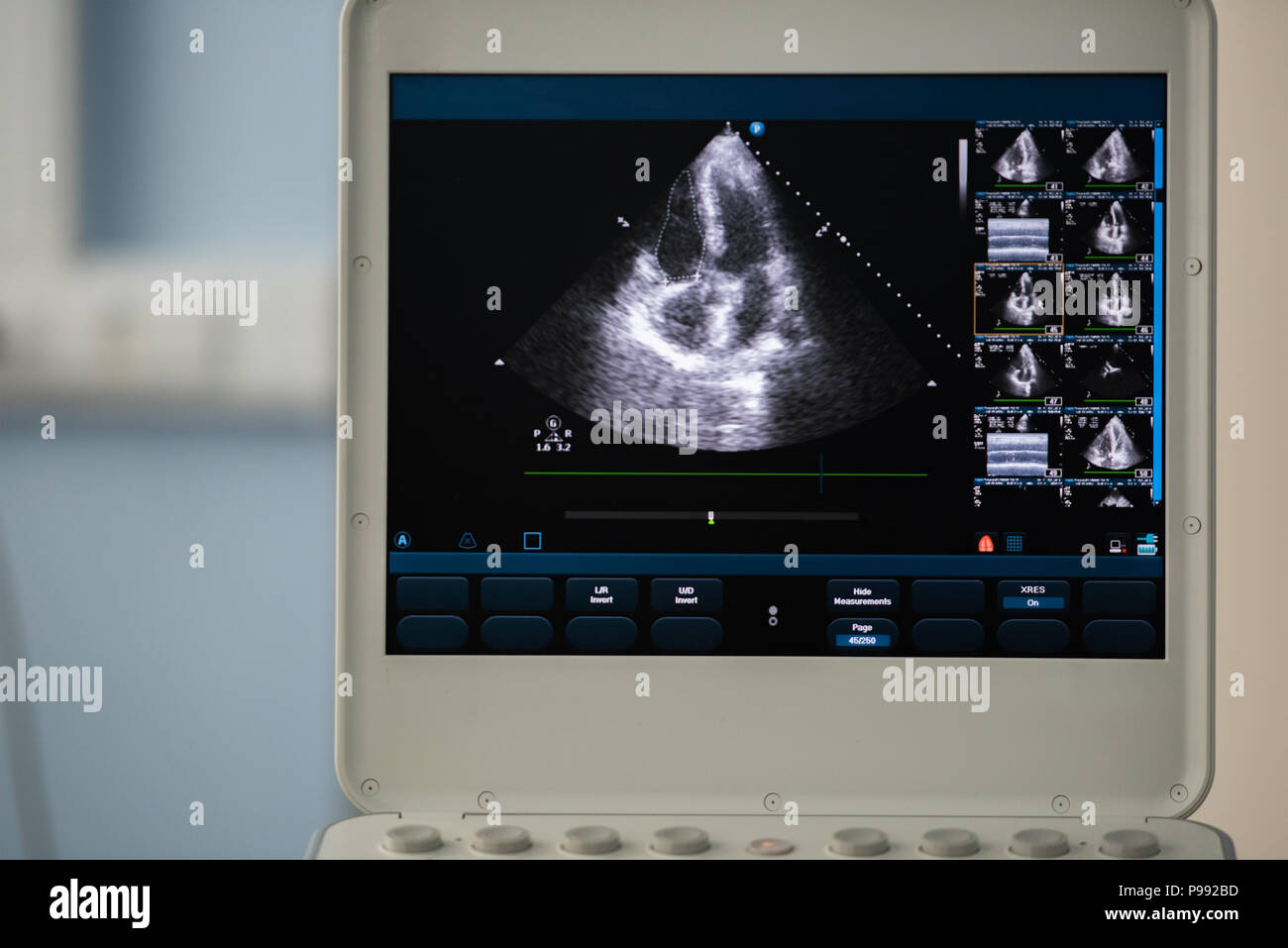 The screen of the ultrasound device shows a scan of the heart in a four ...