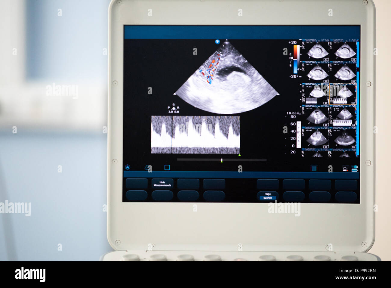 On the screen of an ultrasound machine is an image of a saggital scan ...