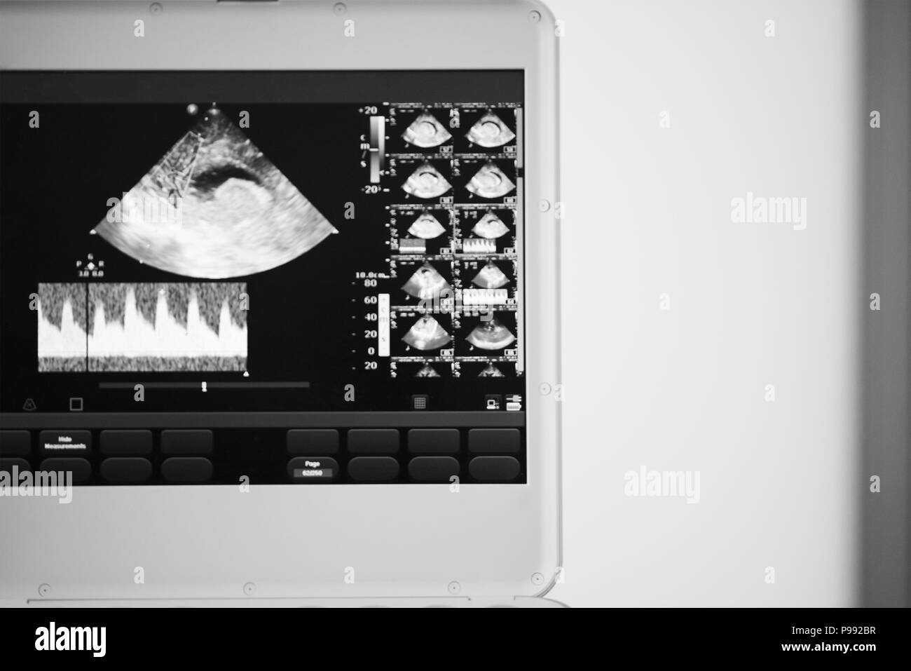 On the screen of an ultrasound machine is an image of a saggital scan ...