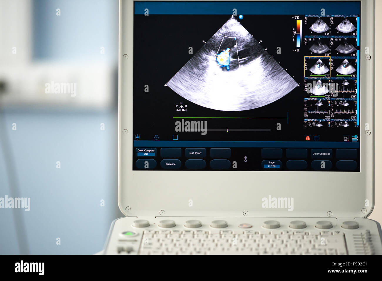 On the screen of an ultrasound device, a heart scan in a four-chamber ...