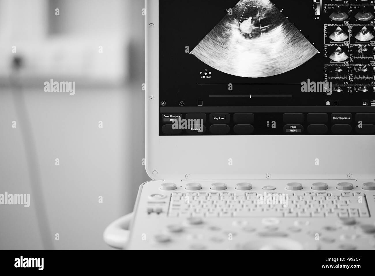 On the screen of an ultrasound device, a heart scan in a four-chamber ...