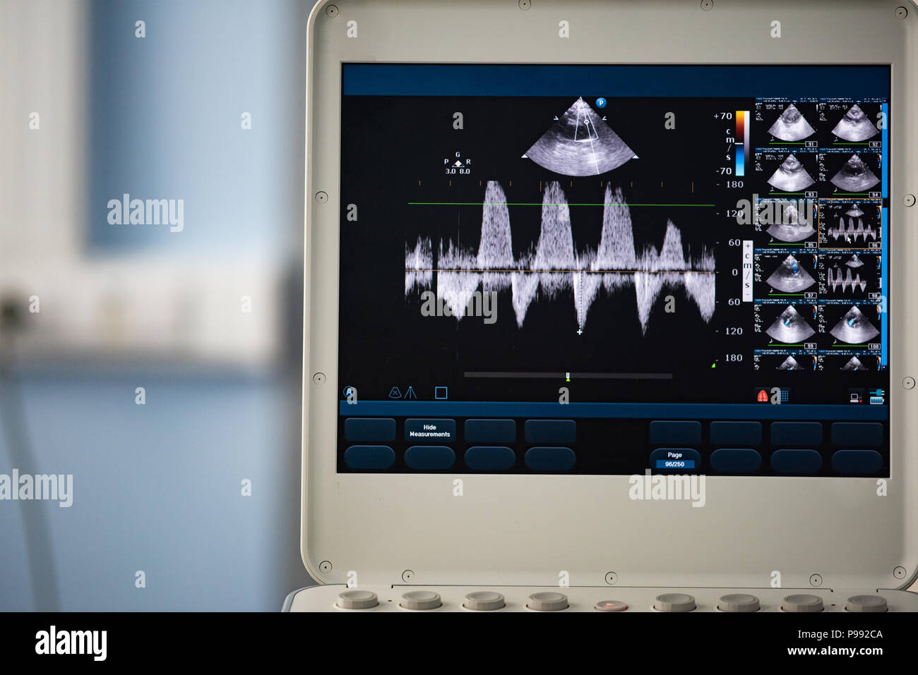 The screen of the ultrasound device with the image of measuring the ...