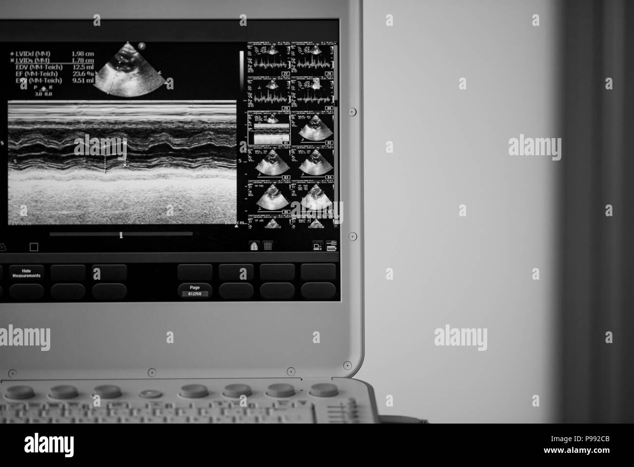 On the screen of the ultrasound apparatus, the scan of the left ...