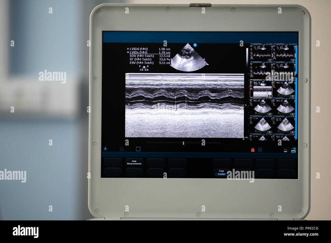 On the screen of the ultrasound apparatus, the scan of the left ...