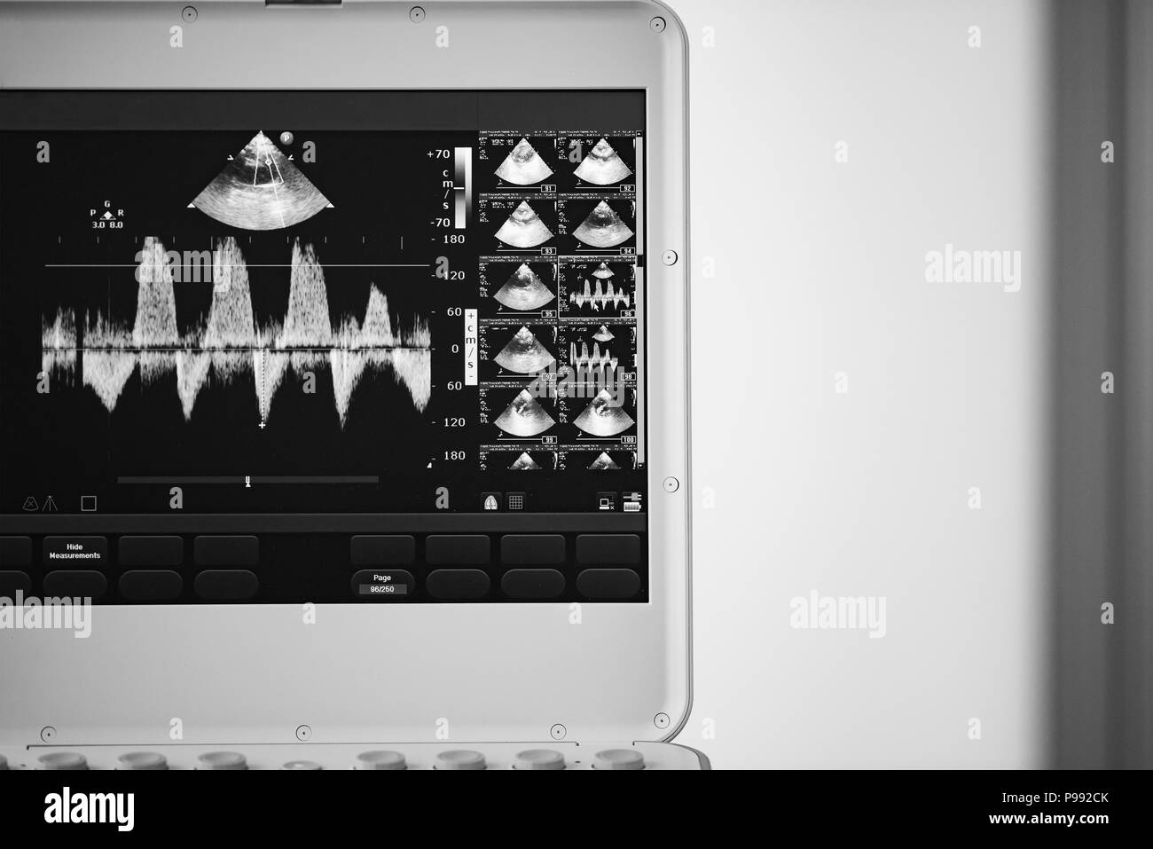 The screen of the apparatus for ultrasound examination showing the ...