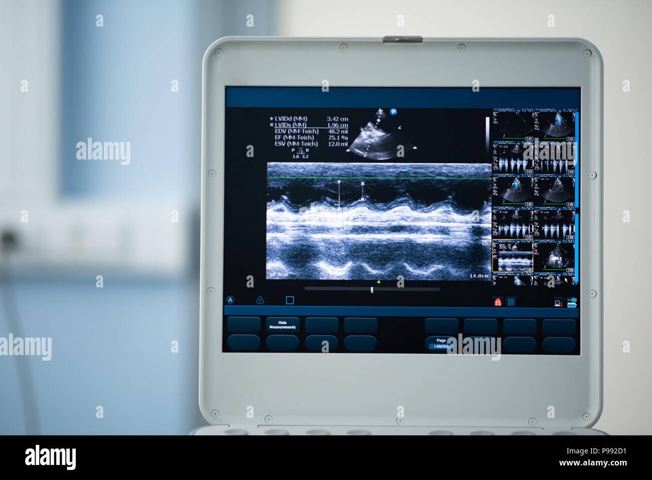 On the screen of the ultrasound apparatus, the scan of the left ...