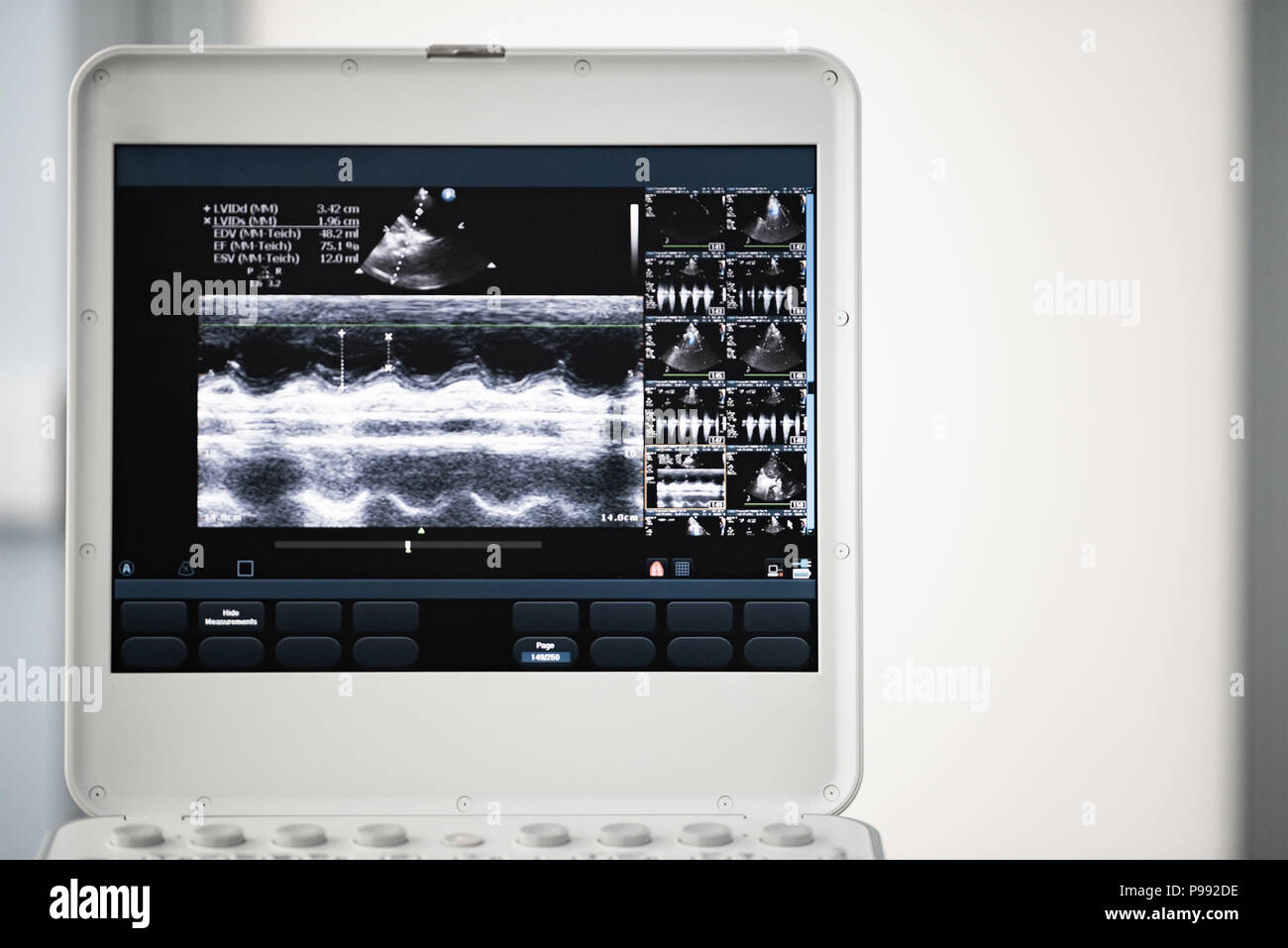 On the screen of the ultrasound apparatus, the scan of the left ...
