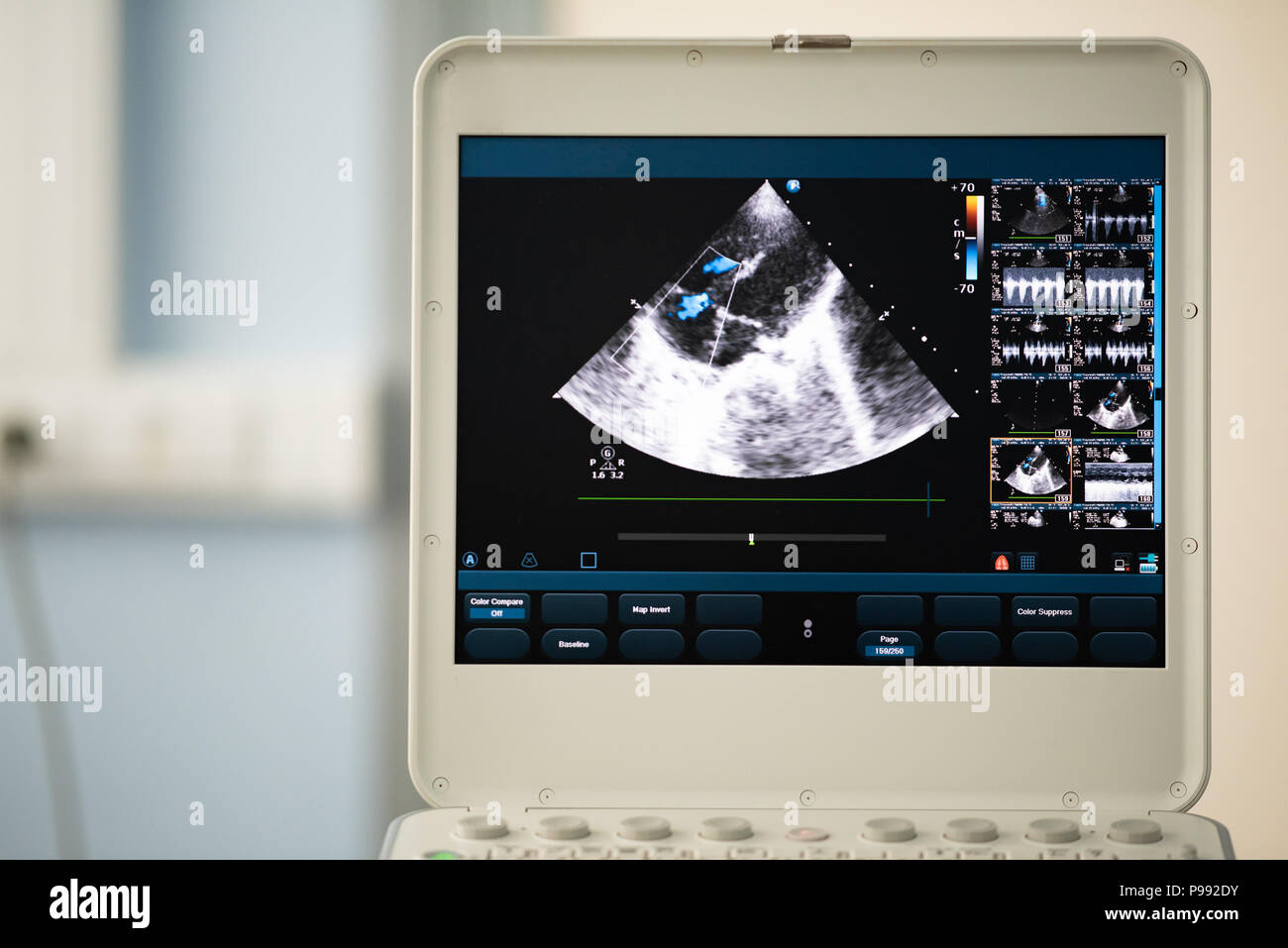 On the ultrasound screen, the image of the heart in the four-chamber ...
