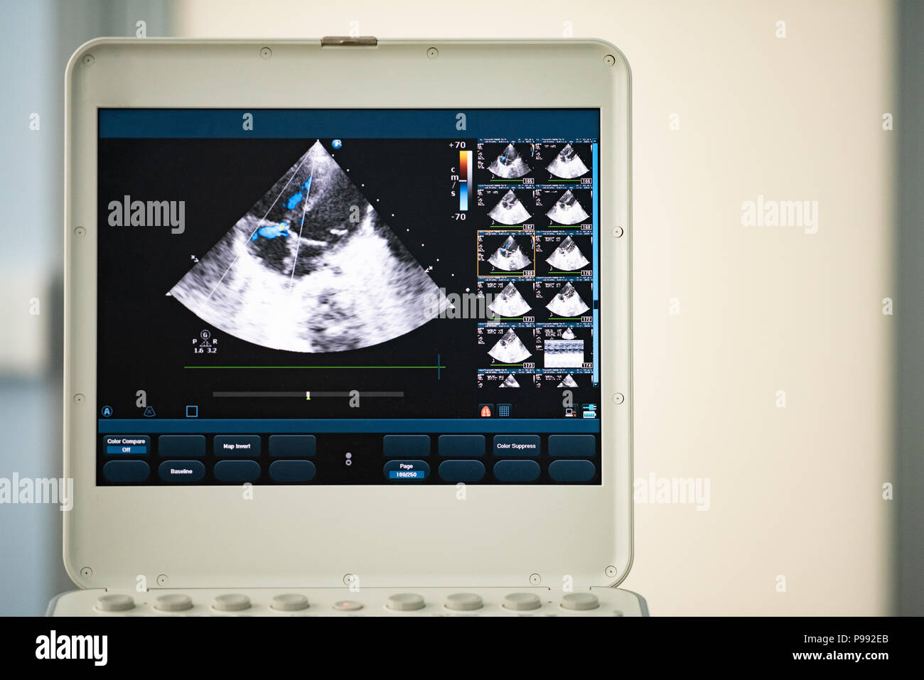 On the ultrasound screen, the image of the heart in the four-chamber ...