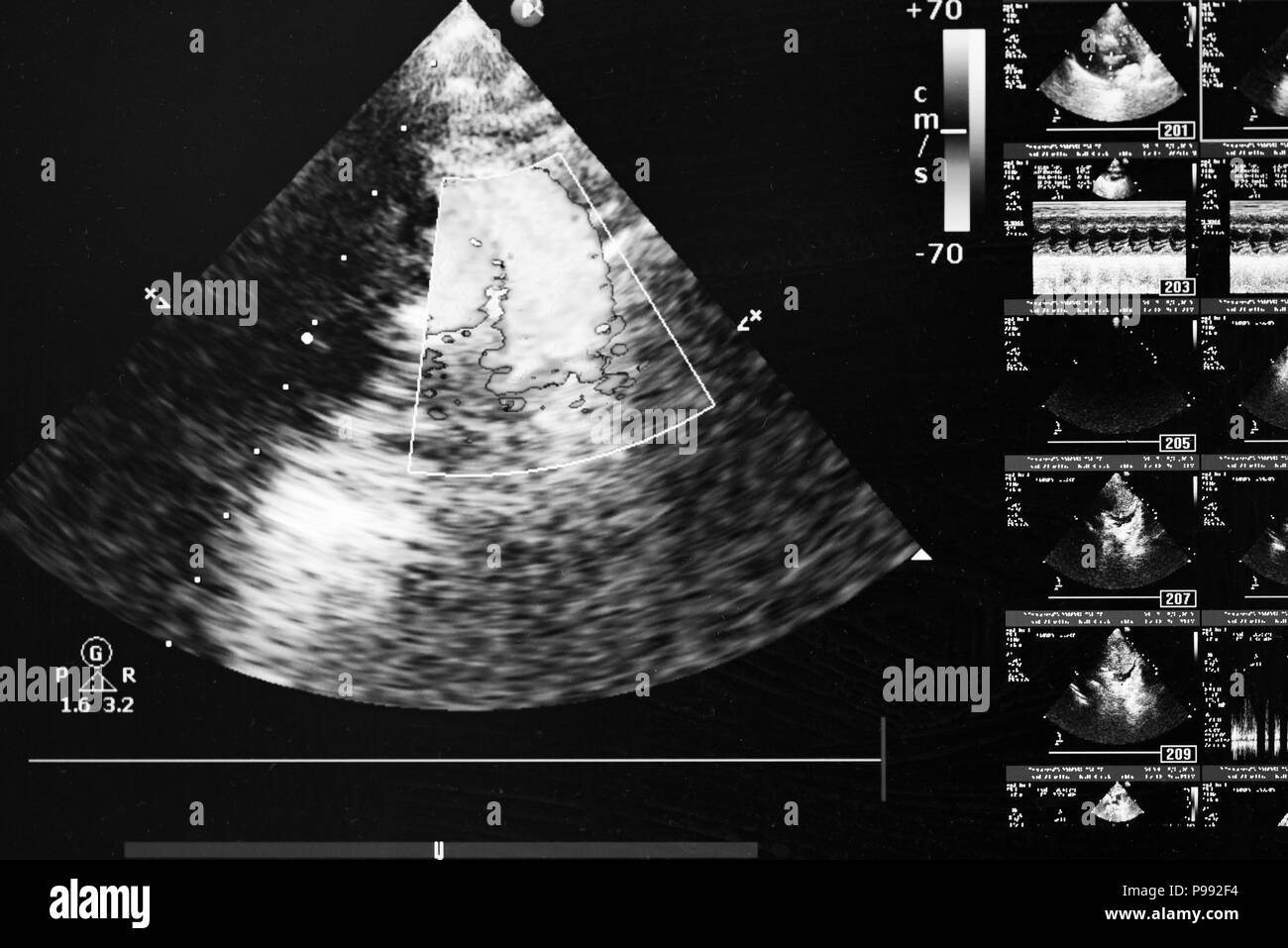 On the screen of a modern ultrasound scanner, the image of the right ...