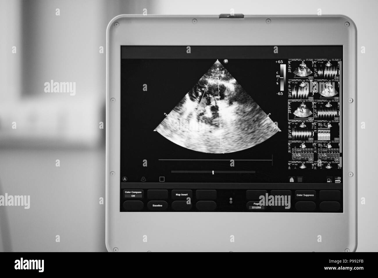 On the screen of a modern ultrasound scanner, an image of the heart ...