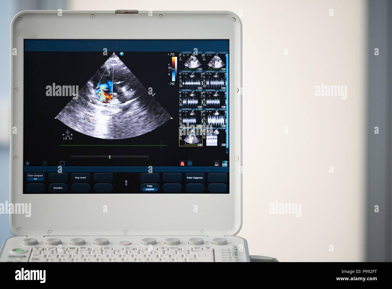 On the screen of a modern ultrasound scanner, an image of the heart ...