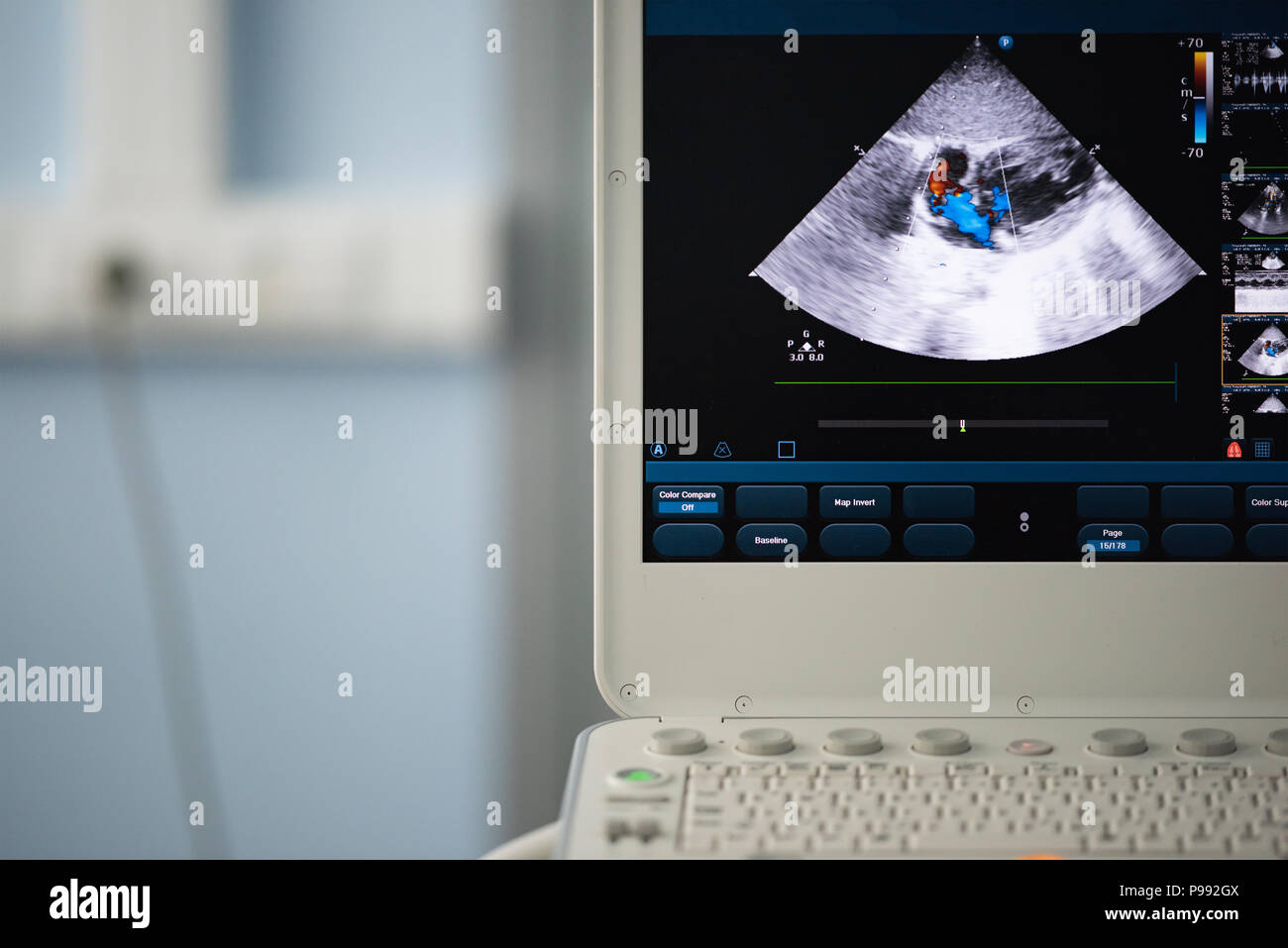 Echocardiogram procedure hi-res stock photography and images - Alamy