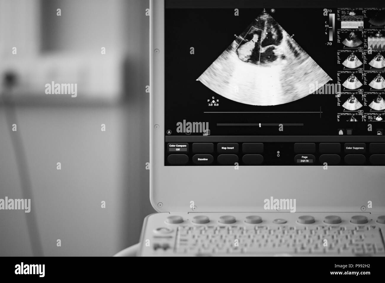 Echocardiogram procedure hi-res stock photography and images - Alamy