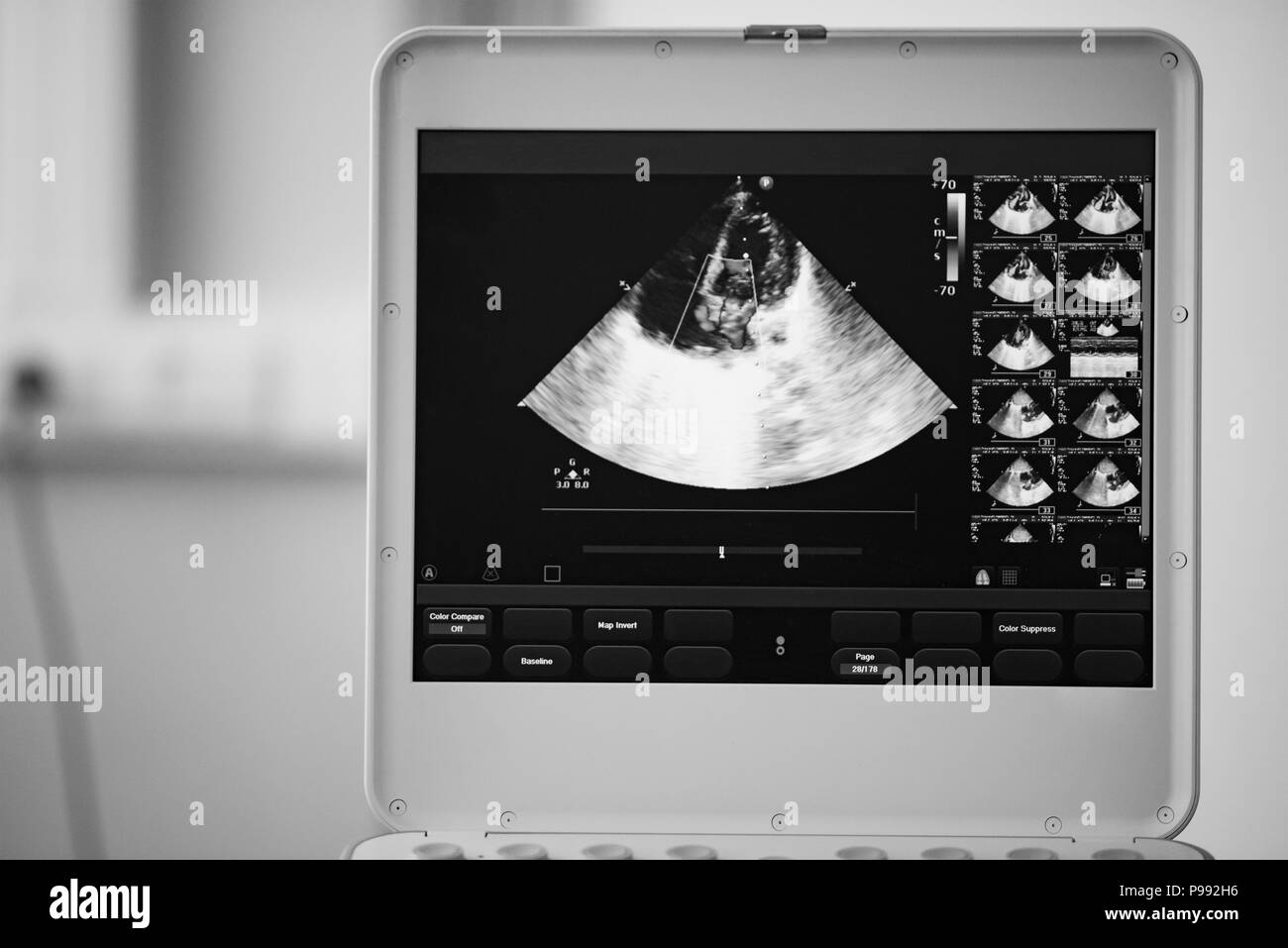 On the screen of the ultrasound scanner, the heart image in the four ...