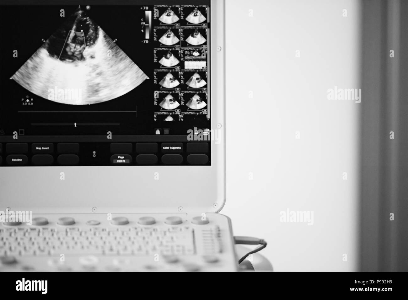On the screen of the ultrasound scanner, the heart image in the four ...