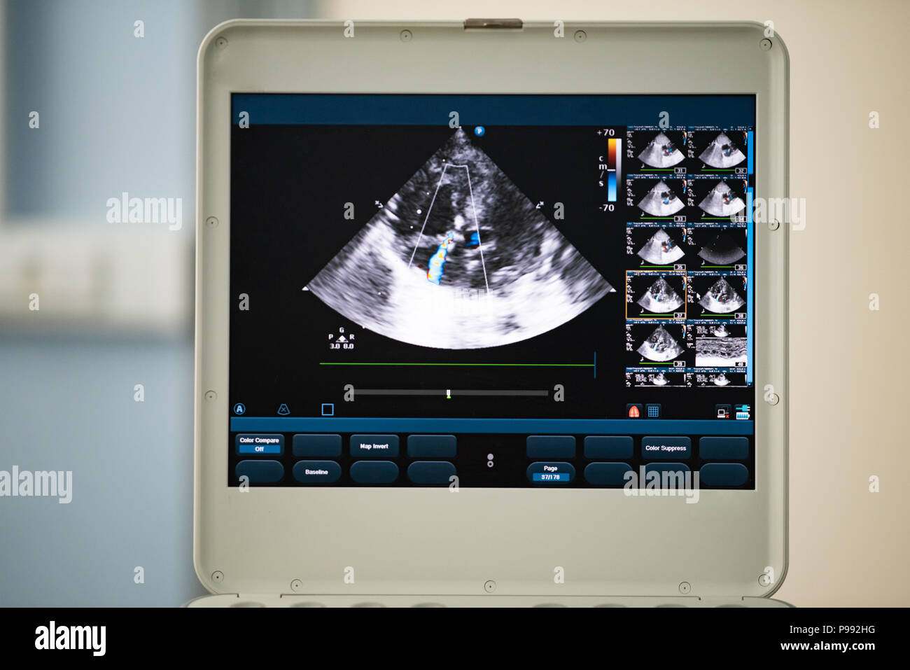 Echocardiogram procedure hi-res stock photography and images - Alamy