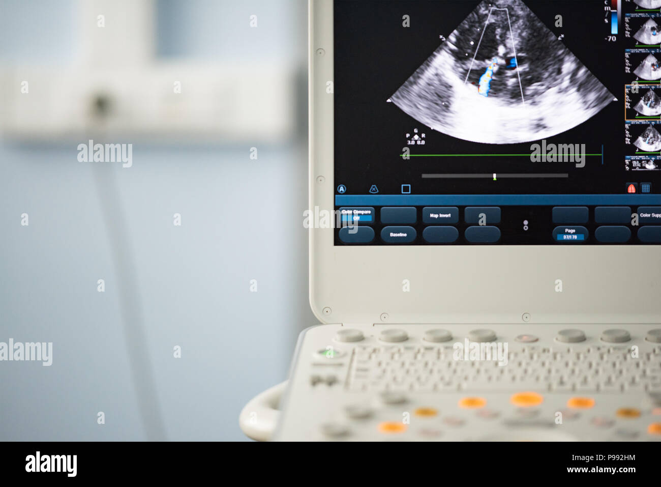 Echocardiogram procedure hi-res stock photography and images - Alamy
