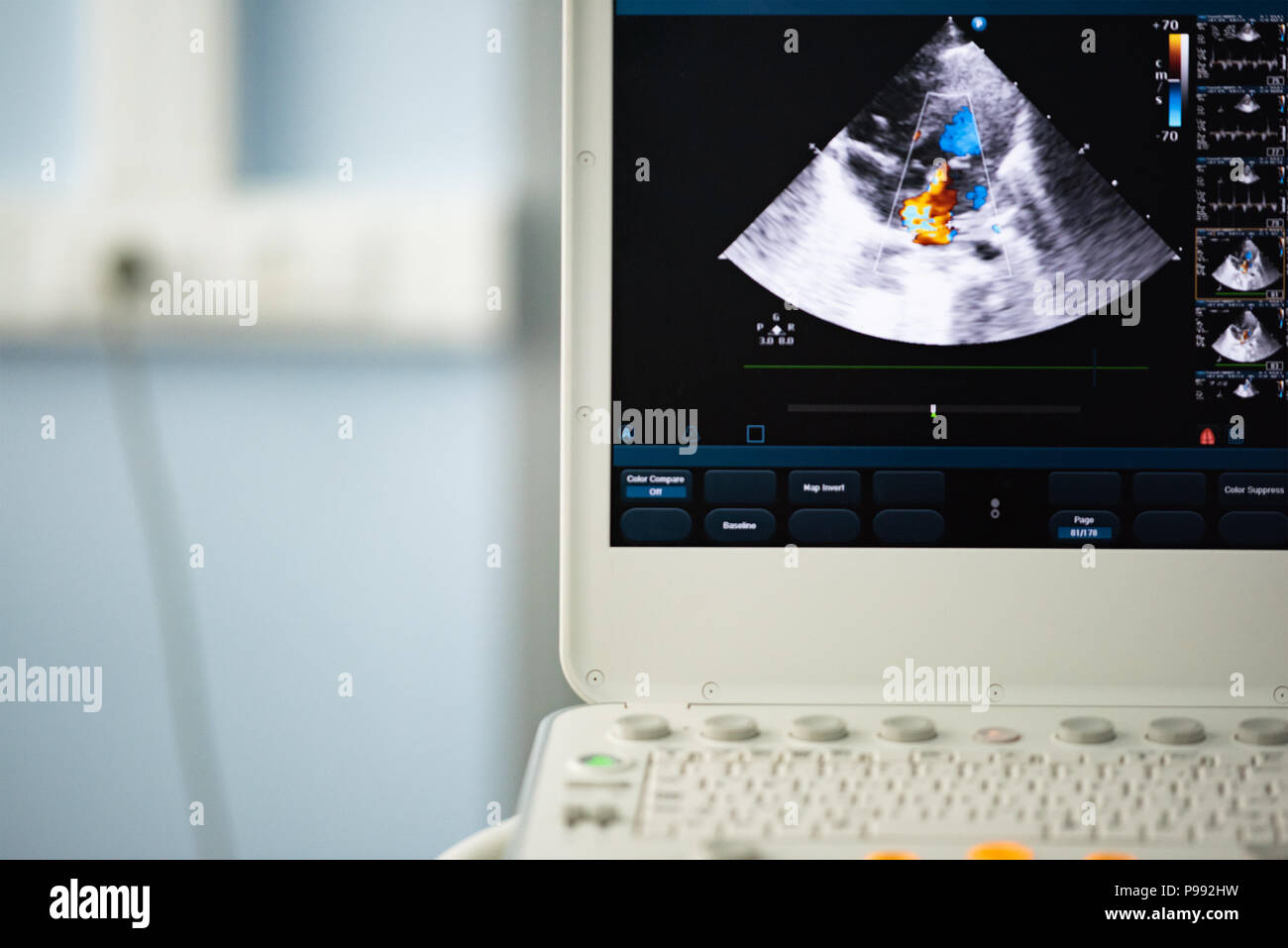 Echocardiogram procedure hi-res stock photography and images - Alamy